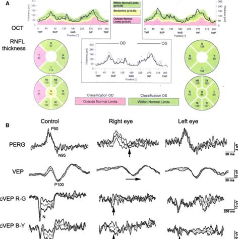 Pattern Reversal Electroretinography Perg P50 Wave Amplitude Left