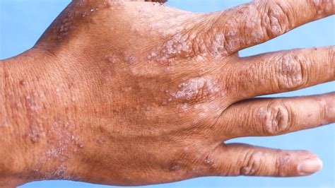 Eczema Refine Clinic