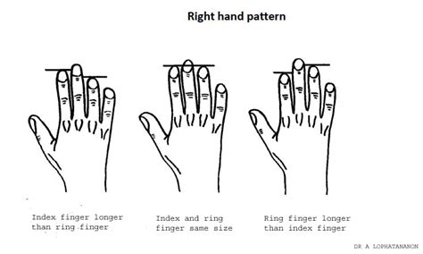 Bbc Ferguss Medical Files Can Finger Length Predict Your Risk Of