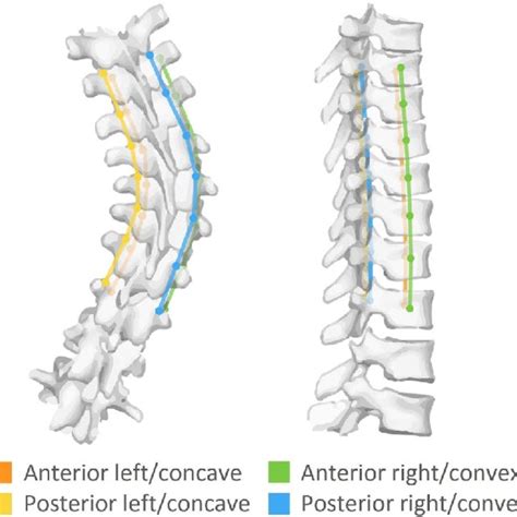 Schematic Figure From A Posterior And Right Side View Of A Right Convex Download Scientific