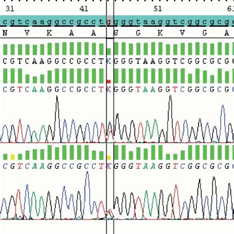 The Hplc Chromatogram Of The Index Patient Showing The Hb Variant