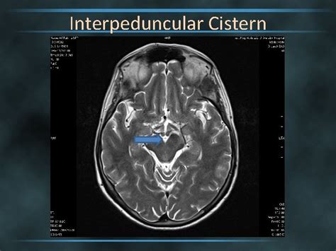 Brain Cisterns Dr Yaser Abdulghani Al Qasimi Mbbs