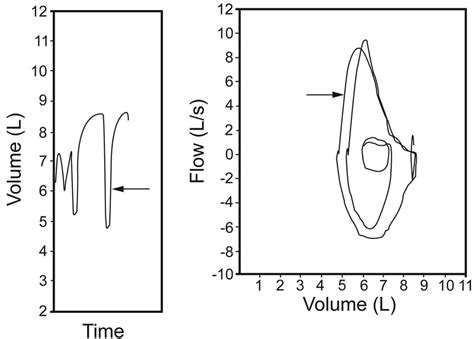 Volume Time Graph And Flow Volume Loops From A Patient Who Consistently Download Scientific