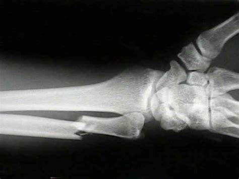 Ulna Ulnar Shaft Fracture Wheeless Textbook Of Orthopaedics