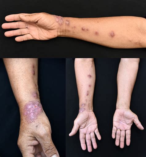 Epidemiological Clinical And Histopathological Characteristics Of