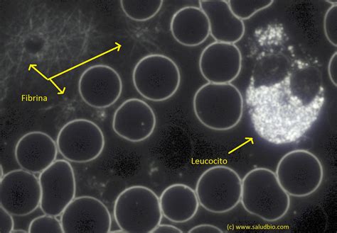 Los Glóbulos Rojos Y La Hemoglobina Saludbio