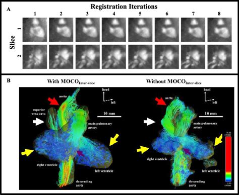 Comparison Of Slice To Volume Reconstructions Svrs With And Without