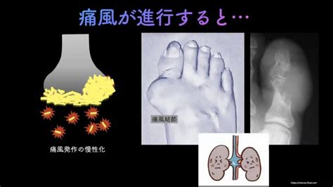 「痛風の患者さんへ【前編】」市民健向講座 2021年度 第1回 複十字病院 公式サイト（東京都 清瀬市）