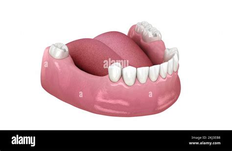 Removable Partial Denture Mandibular Prosthesis Stock Video Footage Alamy