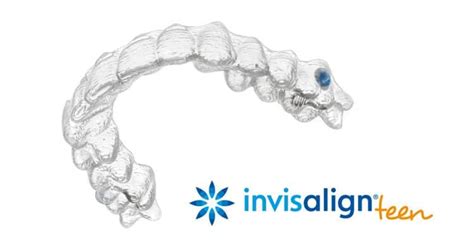 Orthodontists Explain The Invisalign Teen Compliance Indicator