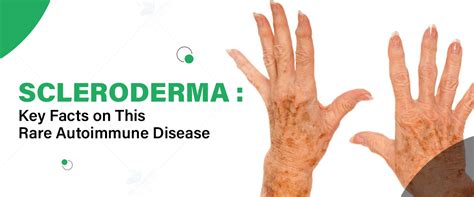 Scleroderma Key Facts About This Rare Autoimmune Disease