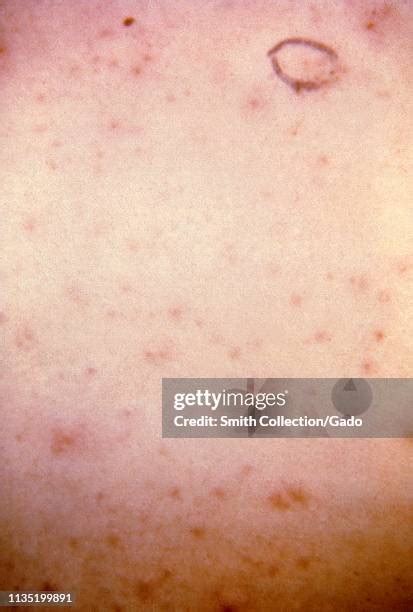 Skin Mites Photos And Premium High Res Pictures Getty Images
