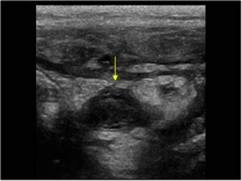 Abdomen And Retroperitoneum 1 5 Appendix Case 1 5 3 Complicated