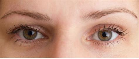 Droopy Eyebrows After Botox Chrysolite Aesthetics Aesthetic Medical Spa
