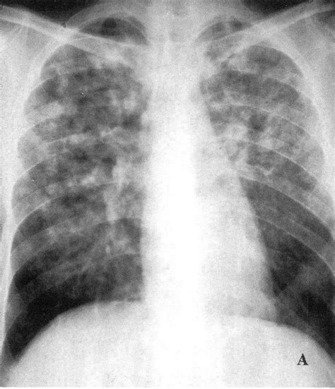 图2—78 肺结核 胸部x线影像学图鉴