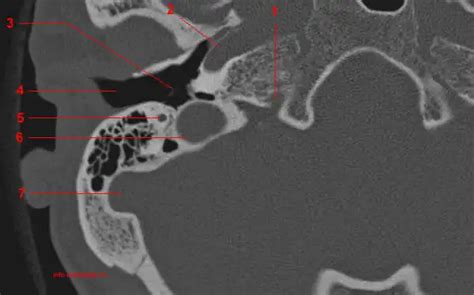 CT Scan Of The Temporal Bone W Radiology