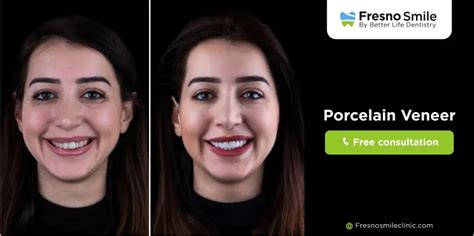 A Deep Dive Into The Pros And Cons Of Porcelain Veneers Fresno Smile