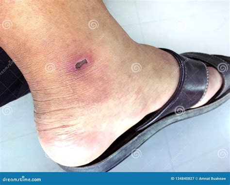 Lesion Scab Dried On The Epidermis Skin Ankle Lesion Dermatitis Dark Spots Of The Skin Legs