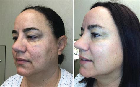 52 Non‐ablative Lasers Plastic Surgery Key