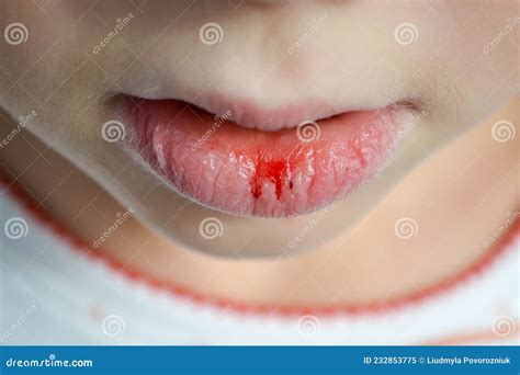 Lips Bleeding Causes At Madeline Mair Blog