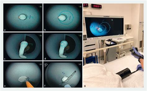 Polyp Size Estimation Using The Visual Scale Endoscope With Linear