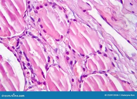 Fibrous Thyroiditis Light Micrograph Stock Image
