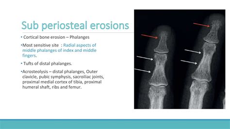 Hyperparathyroidism Imaging Metabolic Bone Diseasepptx