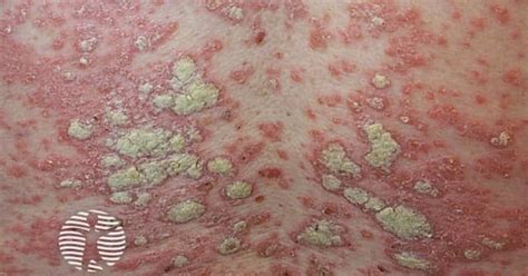 Chronic Plaque Psoriasis Image