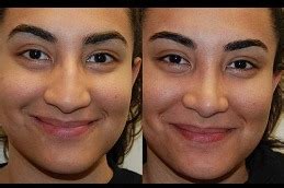 Non Invasive Nose Job Transform Your Look In Dubai Abu Dhabi Cost