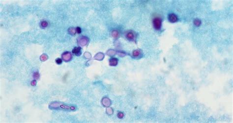 Cryptococcosis Guideline For Better Diagnosis And Treatment • Healthcare In Cryptococcosis Guideline For Better Diagnosis And Treatment • Healthcare In