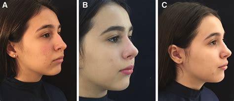 Membrane Placement And Follow Up A A Preoperative View Of The Download Scientific Diagram