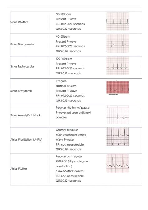 Basic Dysrhythmia And Dysrhythmia Test Questions And Answers Pdf