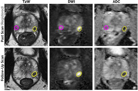 Developing Ai For Clinically Significant Prostate Cancer Diagnosis In Radiology By Anindo Saha