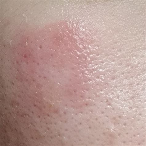 얼굴에 붉은 반점 지식in