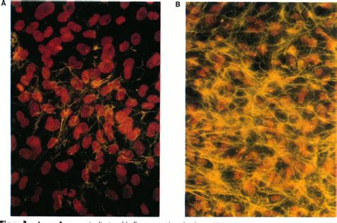 Figure 3 From Unilateral Microfibrillar Abnormalities In A Case Of