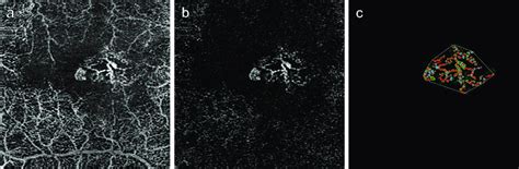 Quantitative Analyses Of Choroidal Neovascularization A The Download Scientific Diagram