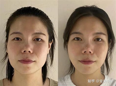 关于童颜针你想知道的都在这里童颜针到底是什么有什么作用该不该打多少钱 知乎