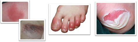 Pressure Ulcers Swan Medical Group