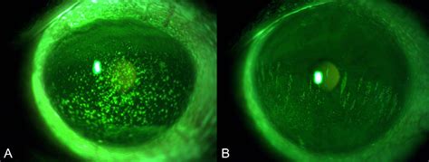 Fluorescein Dye Staining At Tina Kemp Blog