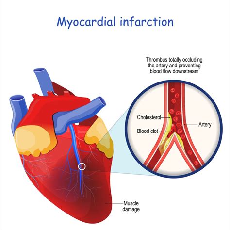 Heart Attack Causes Risk Factors Symptoms Treatment