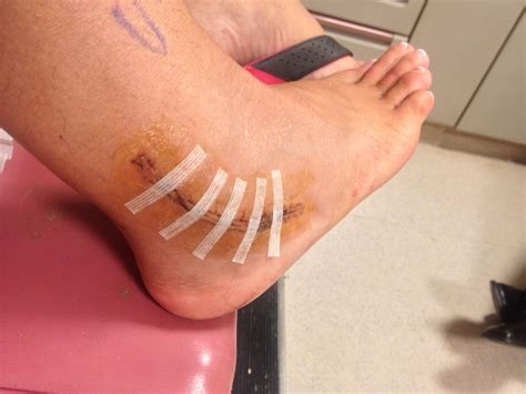 The Surgical Recovery Of And Surviving A Fully Ruptured Peroneal Long