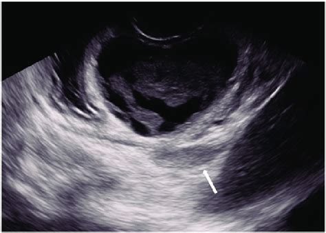 Eus Revealed A Cystic Tumor With Solid Component Located In The Third Download Scientific