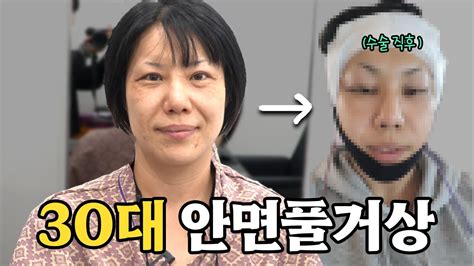 나이가 대수야 동안 성형하고 내 청춘 되찾기 성공👍 Youtube