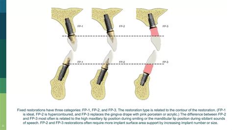 Prosthetic Options In Implant Pptx