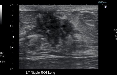 Male Gynecomastia Ultrasound Radiology