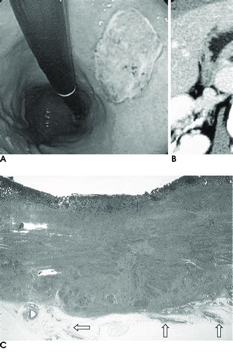 Small Advanced Gastric Cancer In A 52 Year Old Woman A Photograph