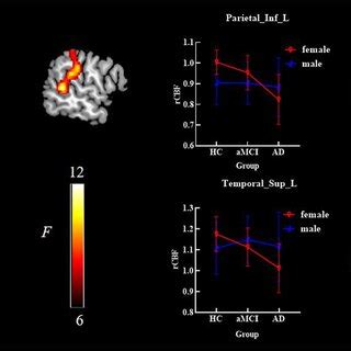 Brain Regions With Sex Group Interaction Effects On RCBF Including Download Scientific