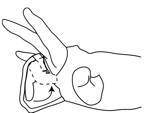 Extension Block Splinting Adapted With Permission From The Journal Of Download Scientific