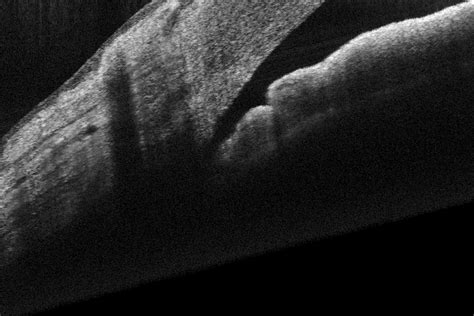 Laser For A Narrow Angle Forrest Eye Care