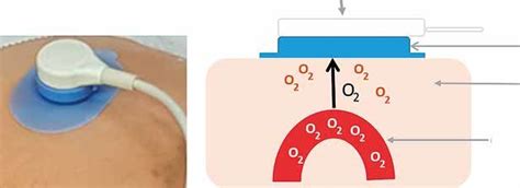 Transcutaneous Oxygen Measurement Download Scientific Diagram